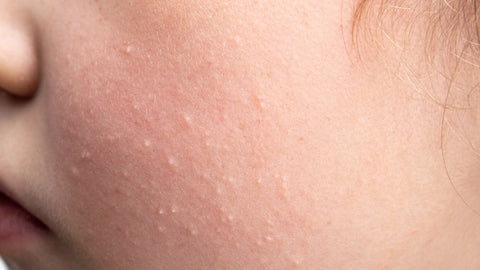 8 Causes of White Spots on Your Child’s Face and How to Treat Them ...